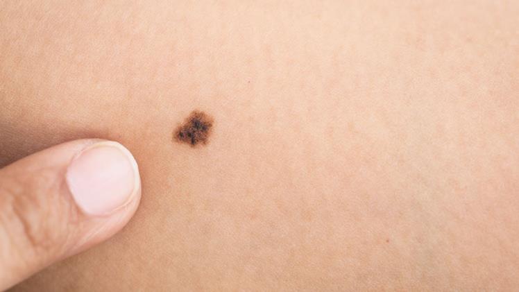 Exploring Skin Mole Pictures: Types, Colors, and Warning Signs ...